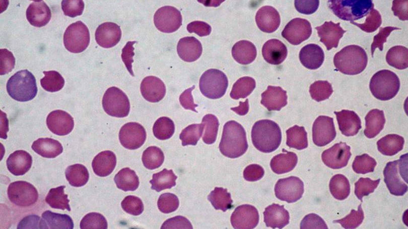 Tese investiga marcadores na Anemia Falciforme pediátrica associados à ...